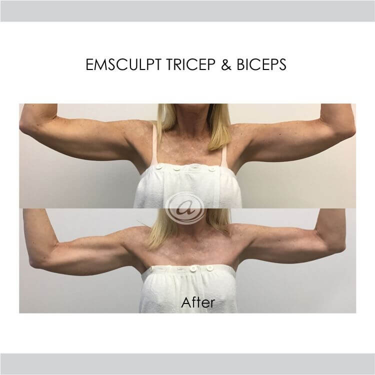 Emsculpt Archives - Cosmetic Dermatology Manhattan Beach | Dr Annie ...