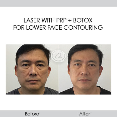 Botox Archives - Cosmetic Dermatology Manhattan Beach | Dr Annie Chiu ...