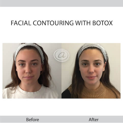 Botox Archives - Cosmetic Dermatology Manhattan Beach | Dr Annie Chiu ...