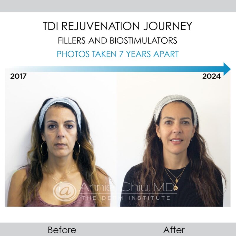 Biostimulator Treatments | Redondo Beach, CA | Dr. Annie Chiu
