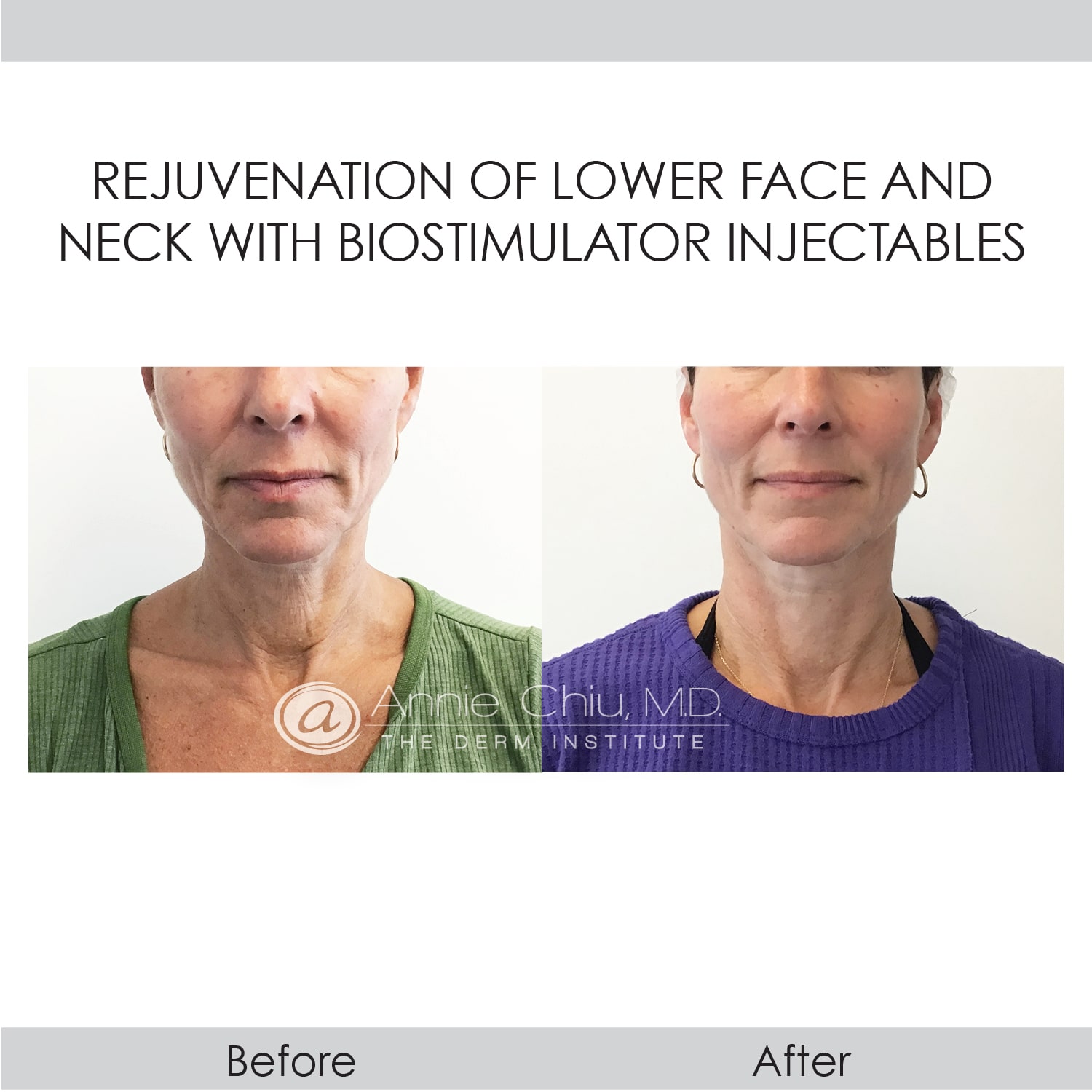 Neck-rejuvenation-biostimulator-Redondo-Beach-min - Cosmetic ...